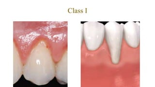 Gingival Recession type defects | PPT