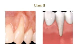 Gingival Recession type defects | PPT