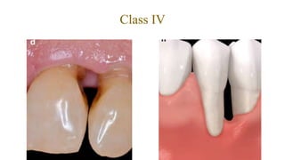 Gingival Recession type defects | PPT