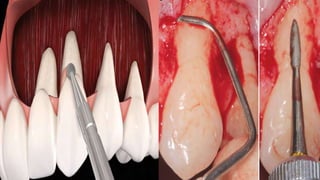 Gingival Recession type defects | PPT