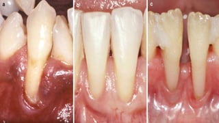 Gingival Recession type defects | PPT