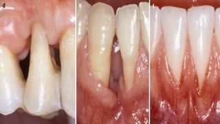Gingival Recession type defects | PPT