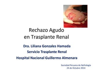RECHAZO AGUDO EN TRASPLANTE RENAL | PPT