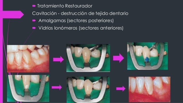 Recidiva de caries, caries residual y caries