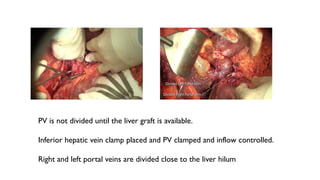 Recipient hepatectomy in liver transplantation | PPTX