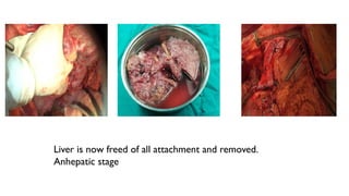 Recipient hepatectomy in liver transplantation | PPTX