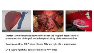 Recipient hepatectomy in liver transplantation | PPTX