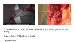Recipient hepatectomy in liver transplantation | PPTX