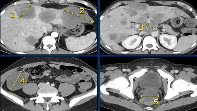 recist criteria Response Evaluation Criteria In Solid Tumors.pptx