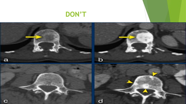 recist criteria Response Evaluation Criteria In Solid Tumors.pptx