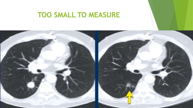recist criteria Response Evaluation Criteria In Solid Tumors.pptx
