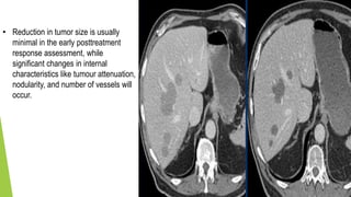 recist criteria Response Evaluation Criteria In Solid Tumors.pptx