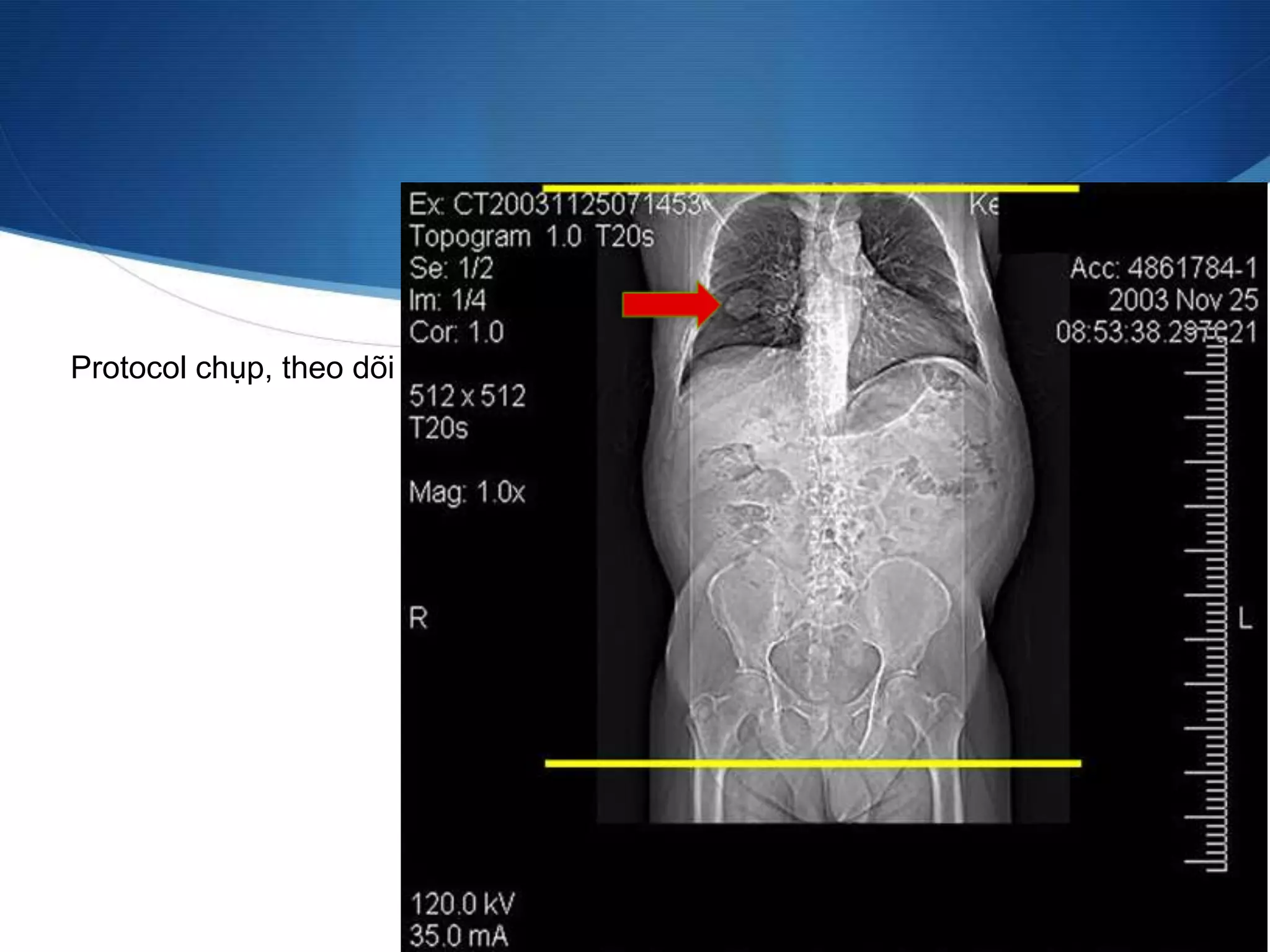 Recist 1.1: PP đánh giá sự đáp ứng của khối u đặc sau điều trị | PPT