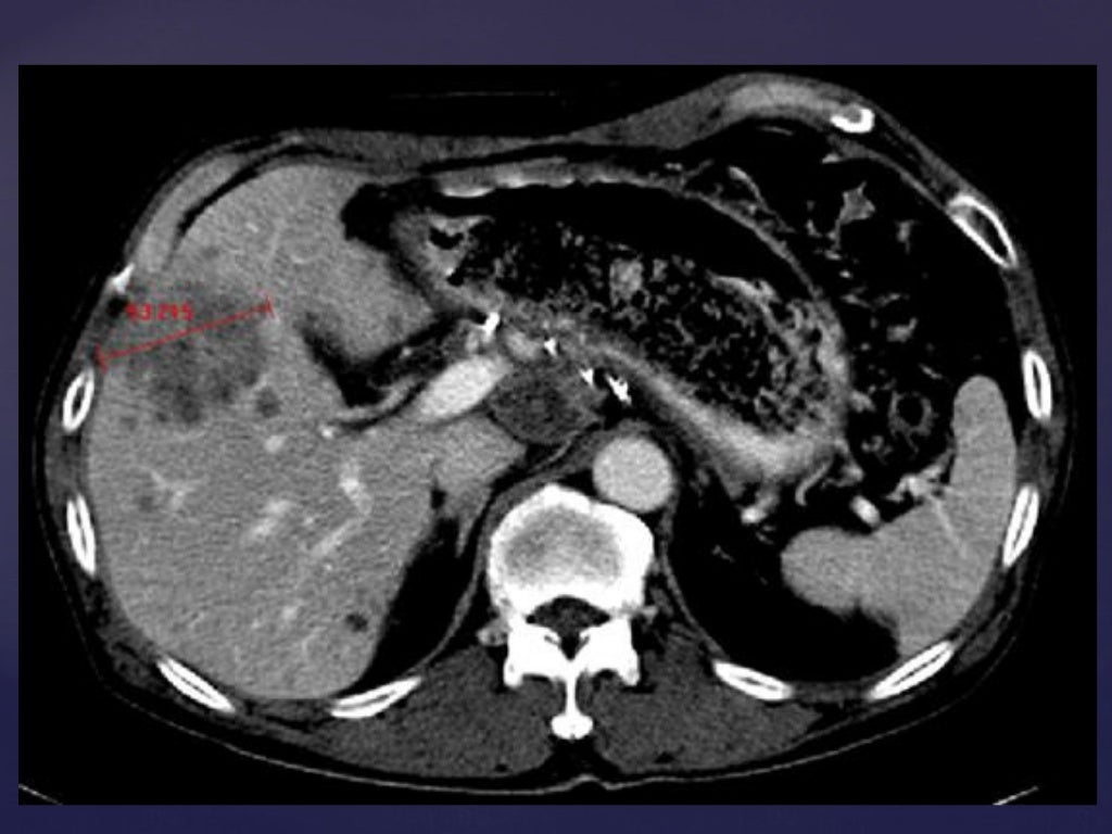 ️Recist 1.1 Worksheet Free Download| Gambr.co