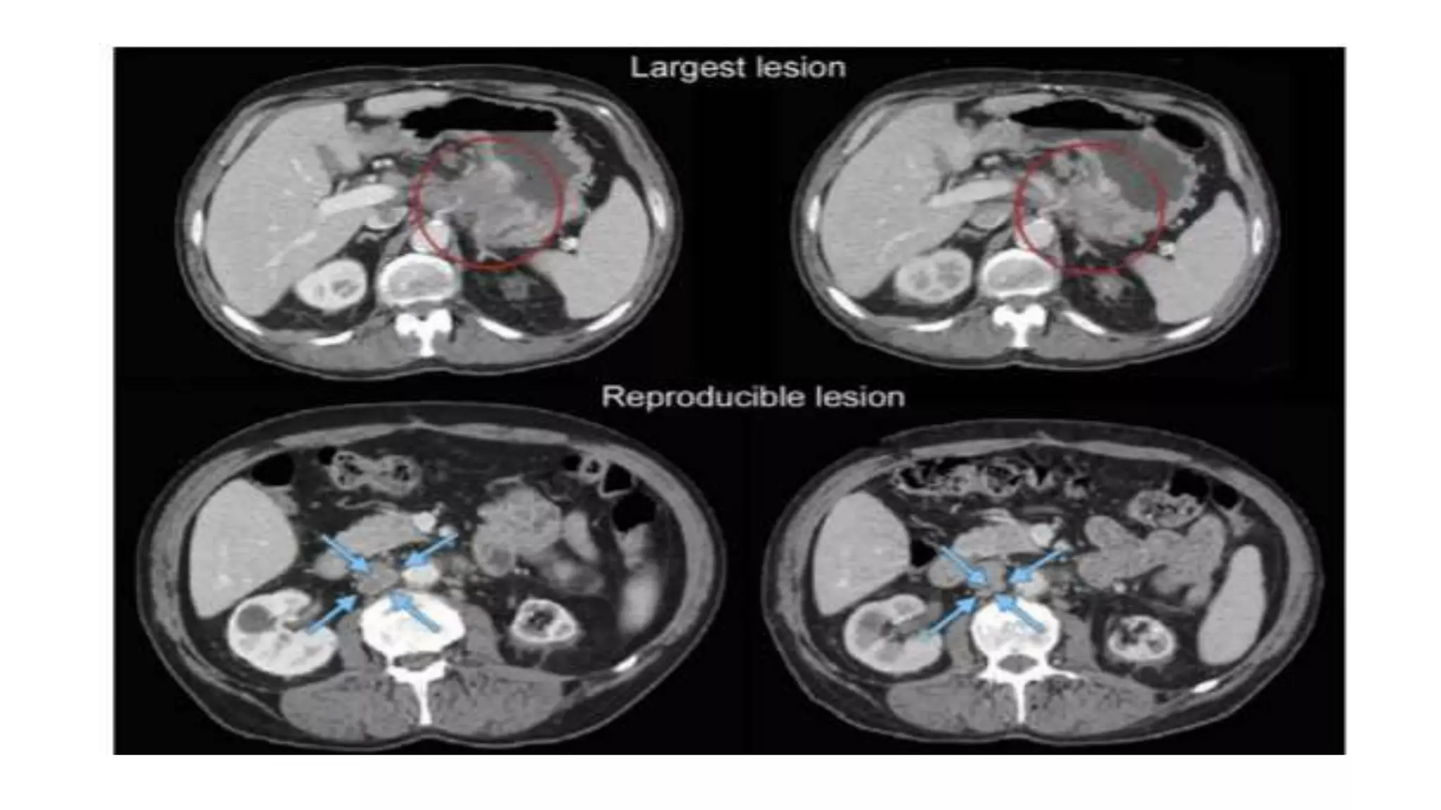 RECIST | PPTX | Cancer | Diseases and Conditions