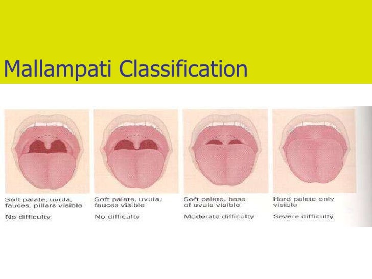 Recognition And Management Of Difficult Airway
