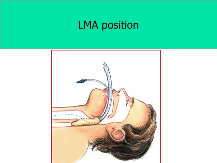 Recognition And Management Of Difficult Airway