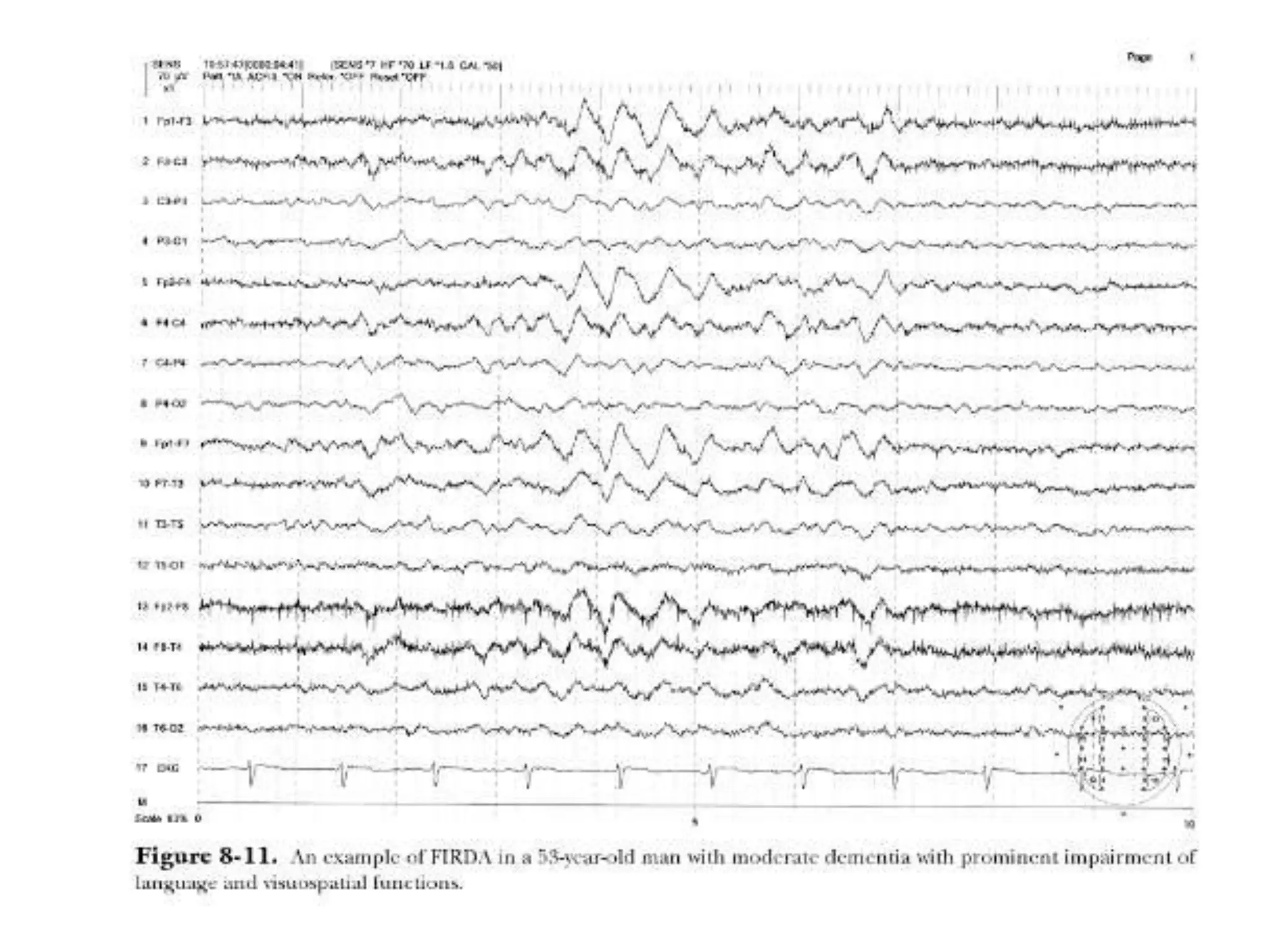 Recognition of abnormal EEG. | PPTX