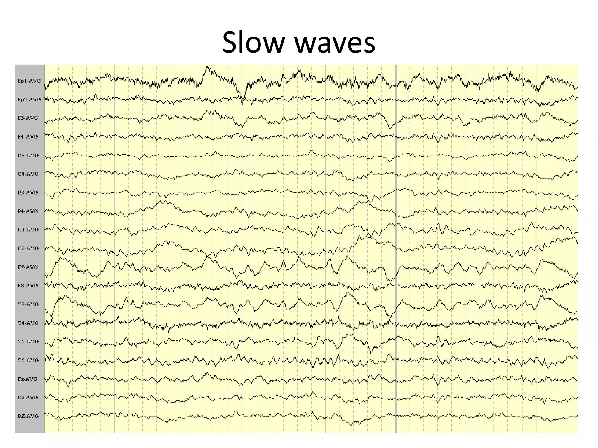 Recognition of abnormal EEG. | PPTX