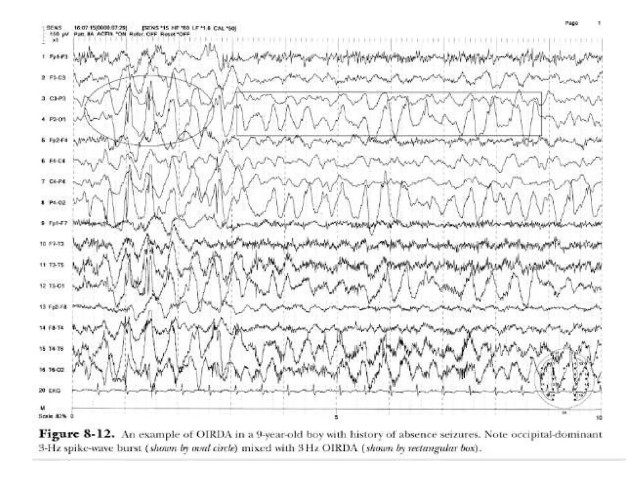 Recognition of abnormal EEG. | PPTX