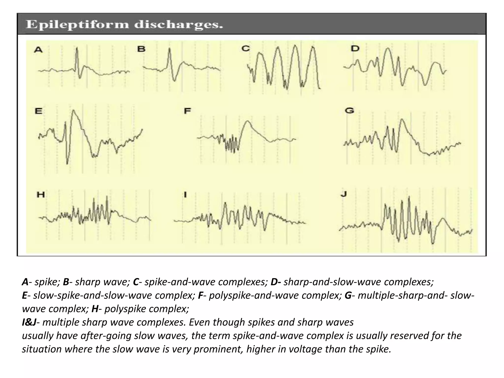 Recognition Of Abnormal Eeg Pptx Brain And Nervous System