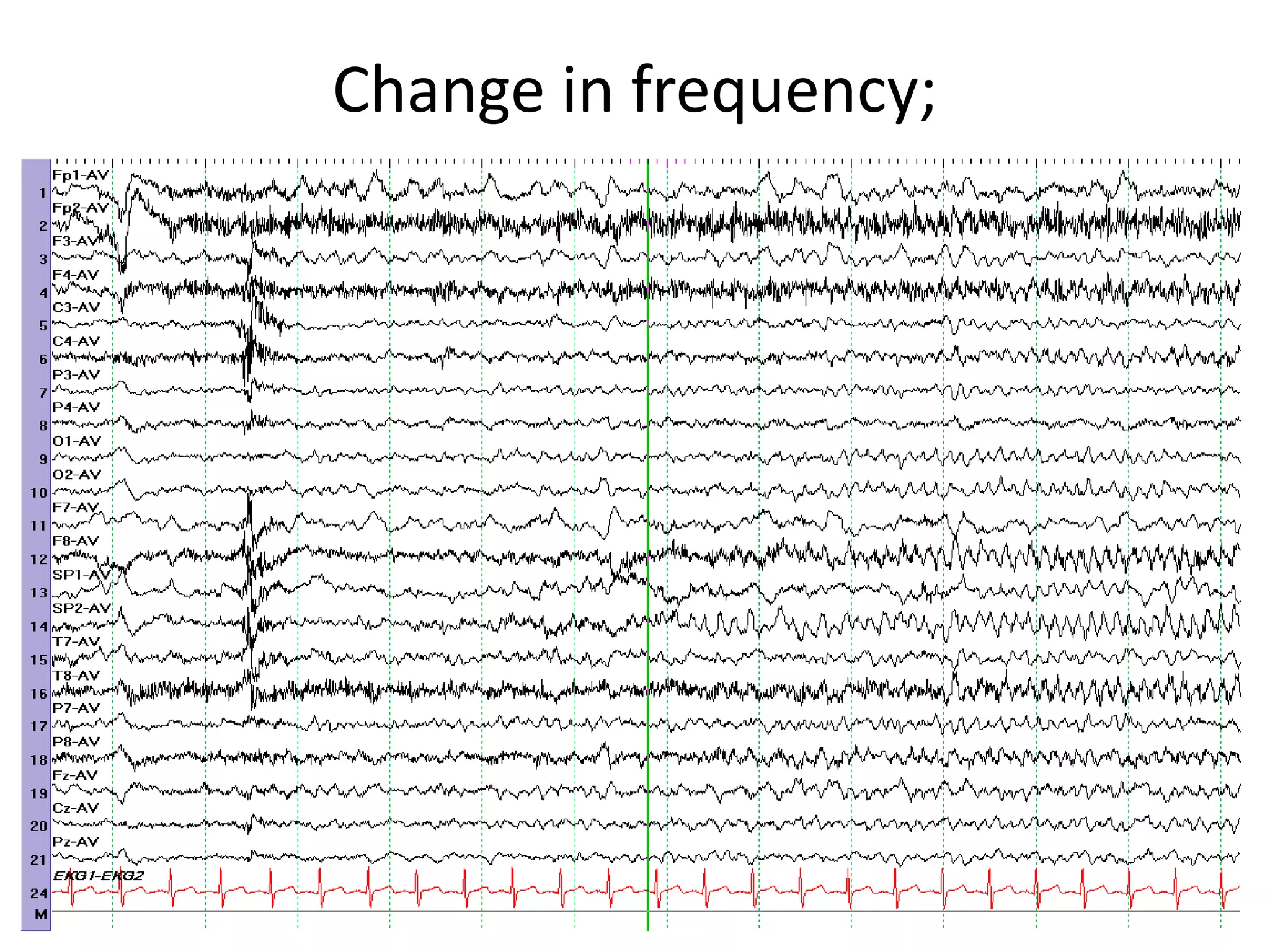 Recognition of abnormal EEG. | PPTX