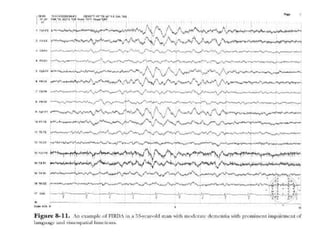 Recognition of abnormal EEG. | PPTX
