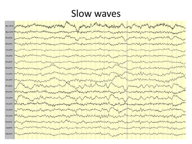 Recognition of abnormal EEG. | PPTX | Brain and Nervous System ...