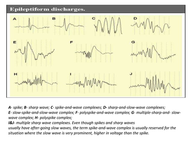 Recognition of abnormal EEG. | PPTX | Brain and Nervous System ...