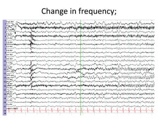 Recognition of abnormal EEG. | PPTX