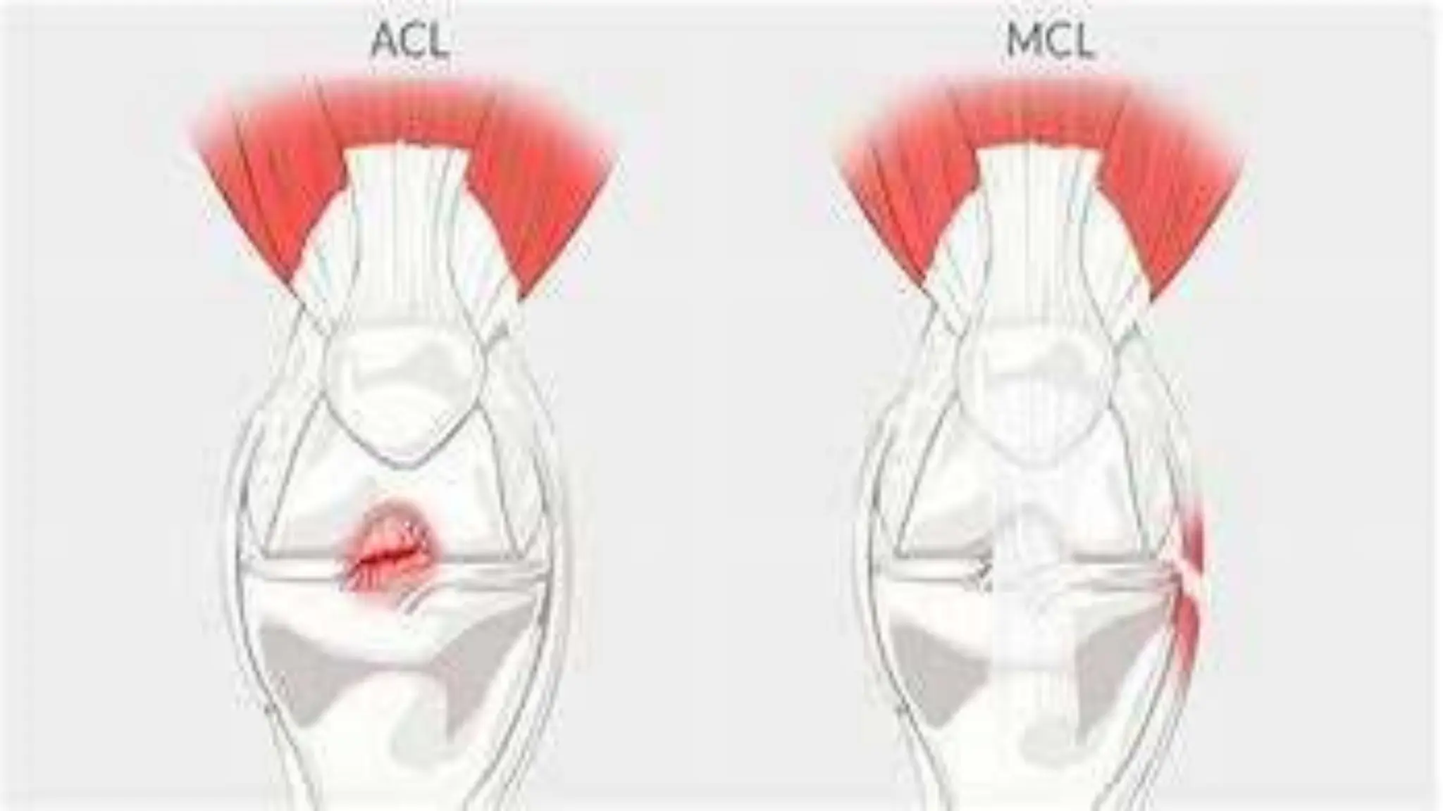 Recognizing sport injuries of upper and lower extremities.pptx