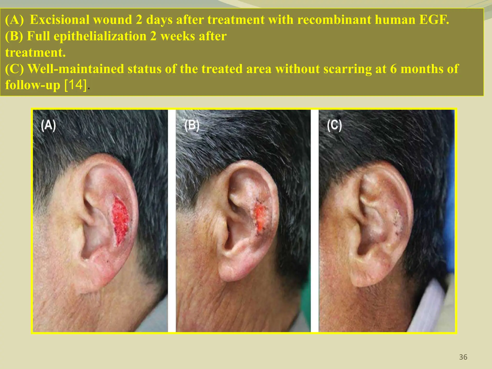 RecombinantHumanEpidermalGrowthFactor-Easyef-.ppt