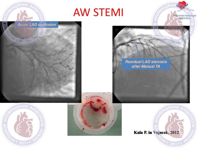 Recommendation for stemi treatment in 2013 and stent for life initiat…