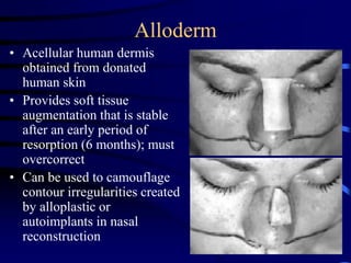 Reconstrução Nasal | PPT