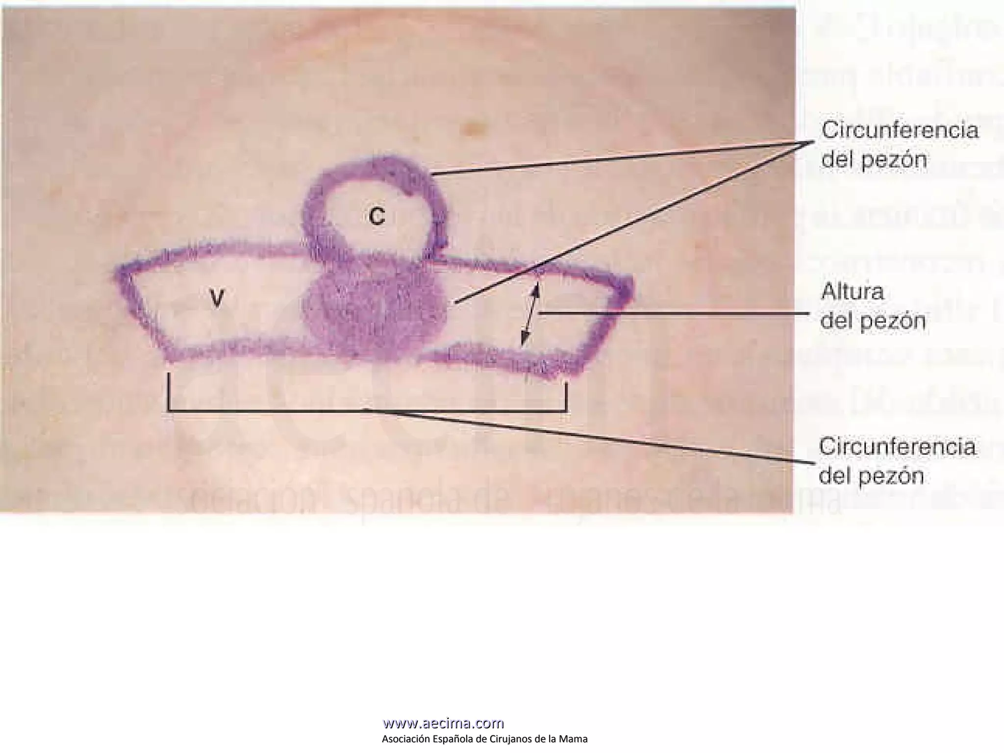 Reconstrucción de complejo areola pezón-1 (2016)