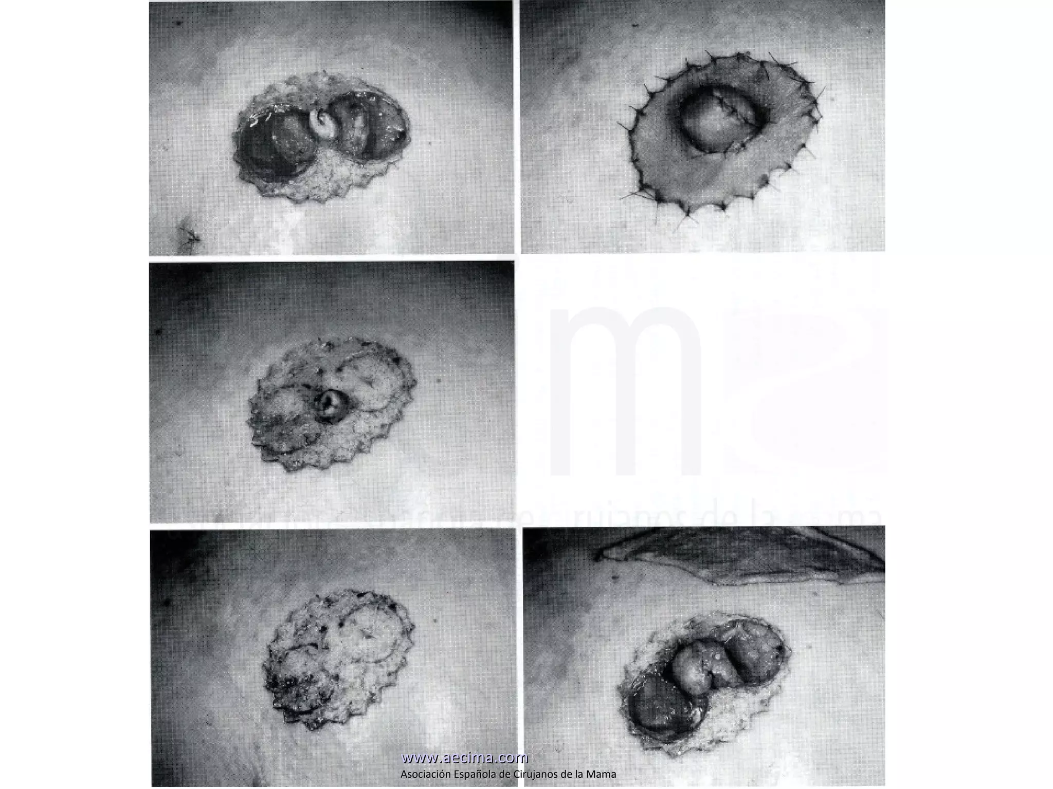 Reconstrucción de complejo areola pezón-1 (2016)
