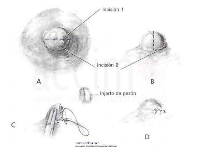 Reconstrucción de complejo areola pezón - Parte 2 (2016)