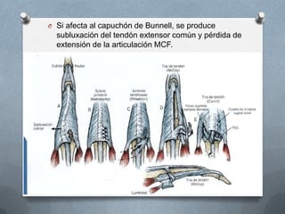 Reconstruccion de lesiones de tendones extensores | PPT