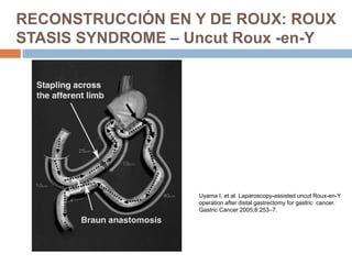 Reconstruccion post gastrectomia distal | PPTX