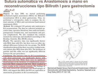 Reconstruccion post gastrectomia distal | PPTX