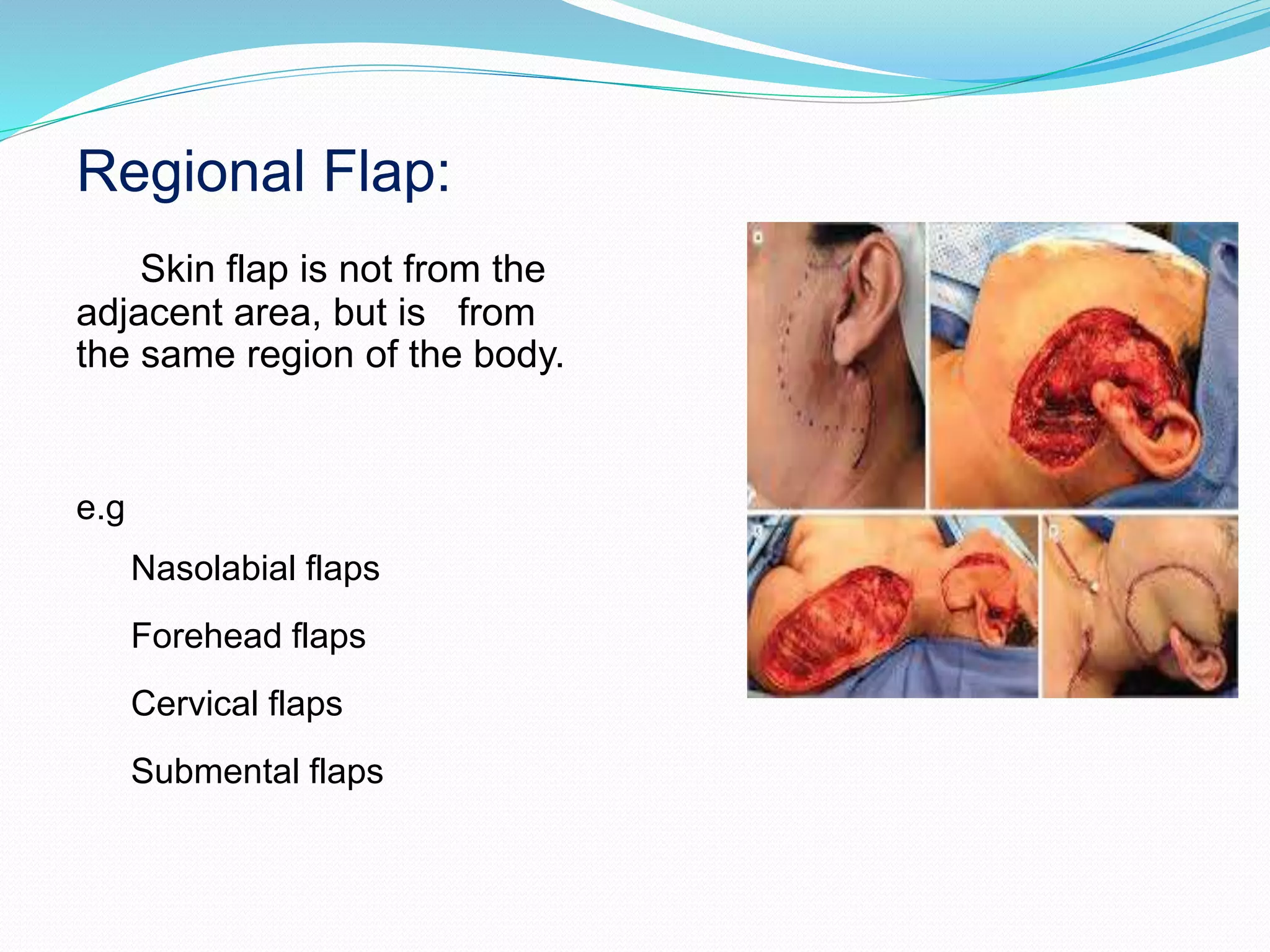 Reconstruction in head and neck surgeries | PPTX