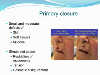 Reconstruction in head and neck surgeries | PPTX