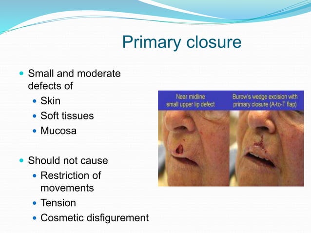 Reconstruction in head and neck surgeries | PPTX