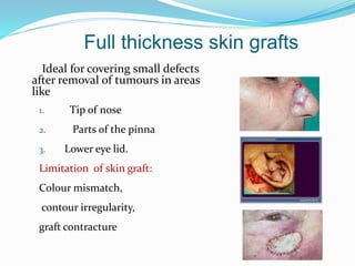 Reconstruction in head and neck surgeries | PPTX