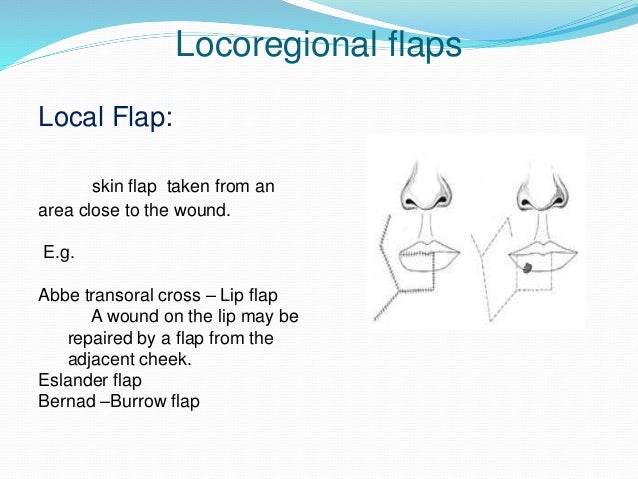 Reconstruction in head and neck surgeries