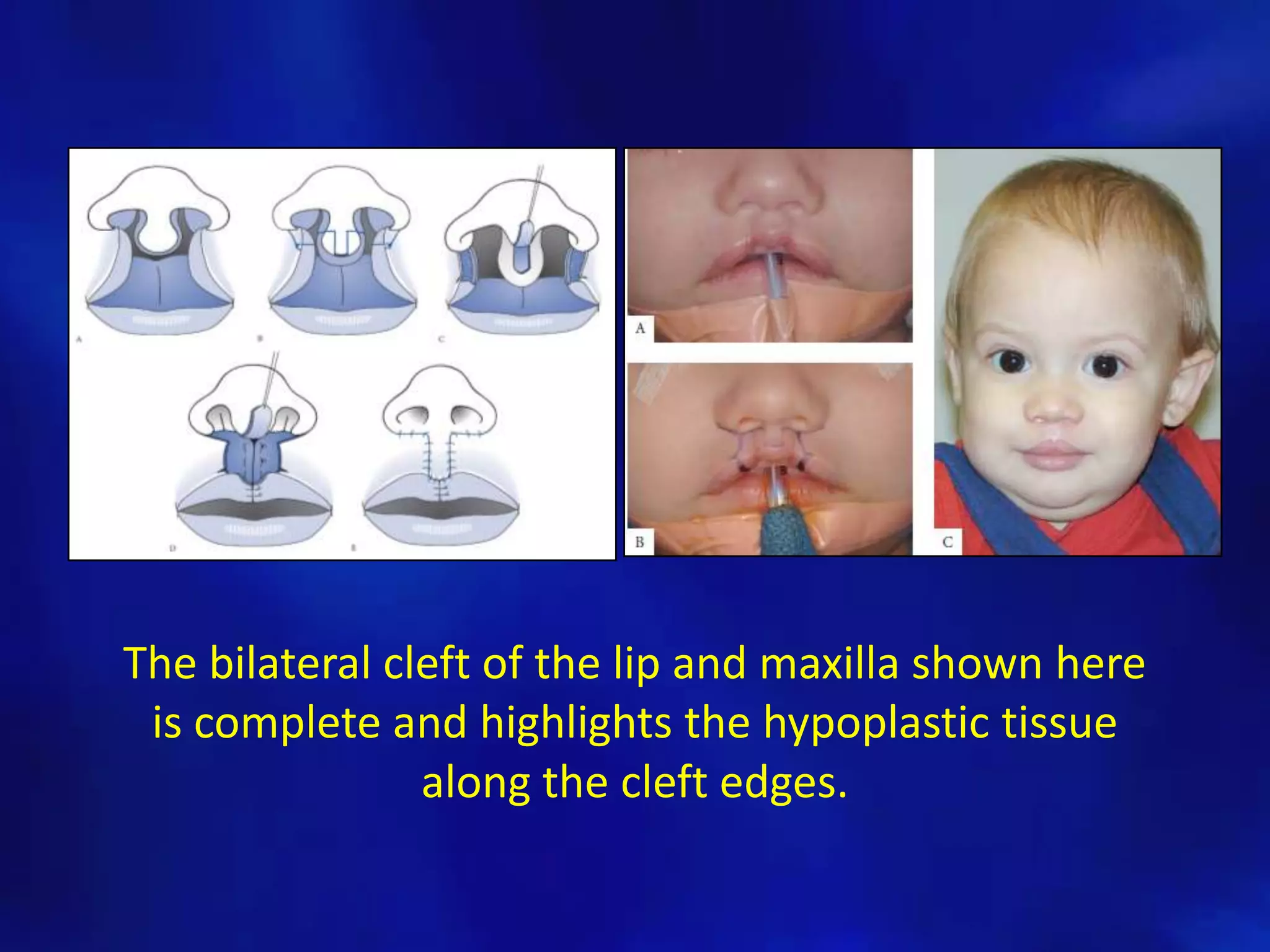 Reconstruction of cleft lip and palate defect | PPTX