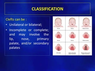 Reconstruction of cleft lip and palate defect | PPTX