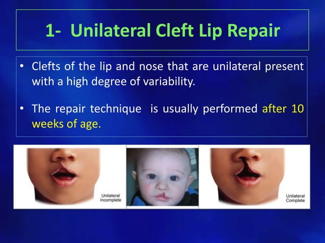 Reconstruction of cleft lip and palate defect | PPTX | Ear, Nose and Throat Conditions ...