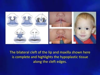 Reconstruction of cleft lip and palate defect | PPTX