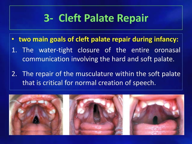 Reconstruction of cleft lip and palate defect | PPTX | Ear, Nose and Throat Conditions ...